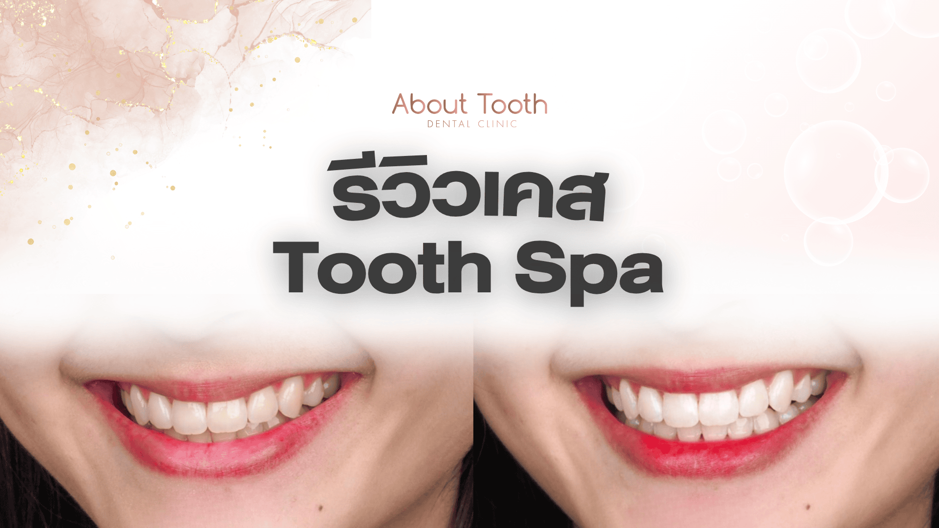 รีวิวแพ็กเกจ Tooth Spa สร้างรอยยิ้มสะอาดสวย | About Tooth