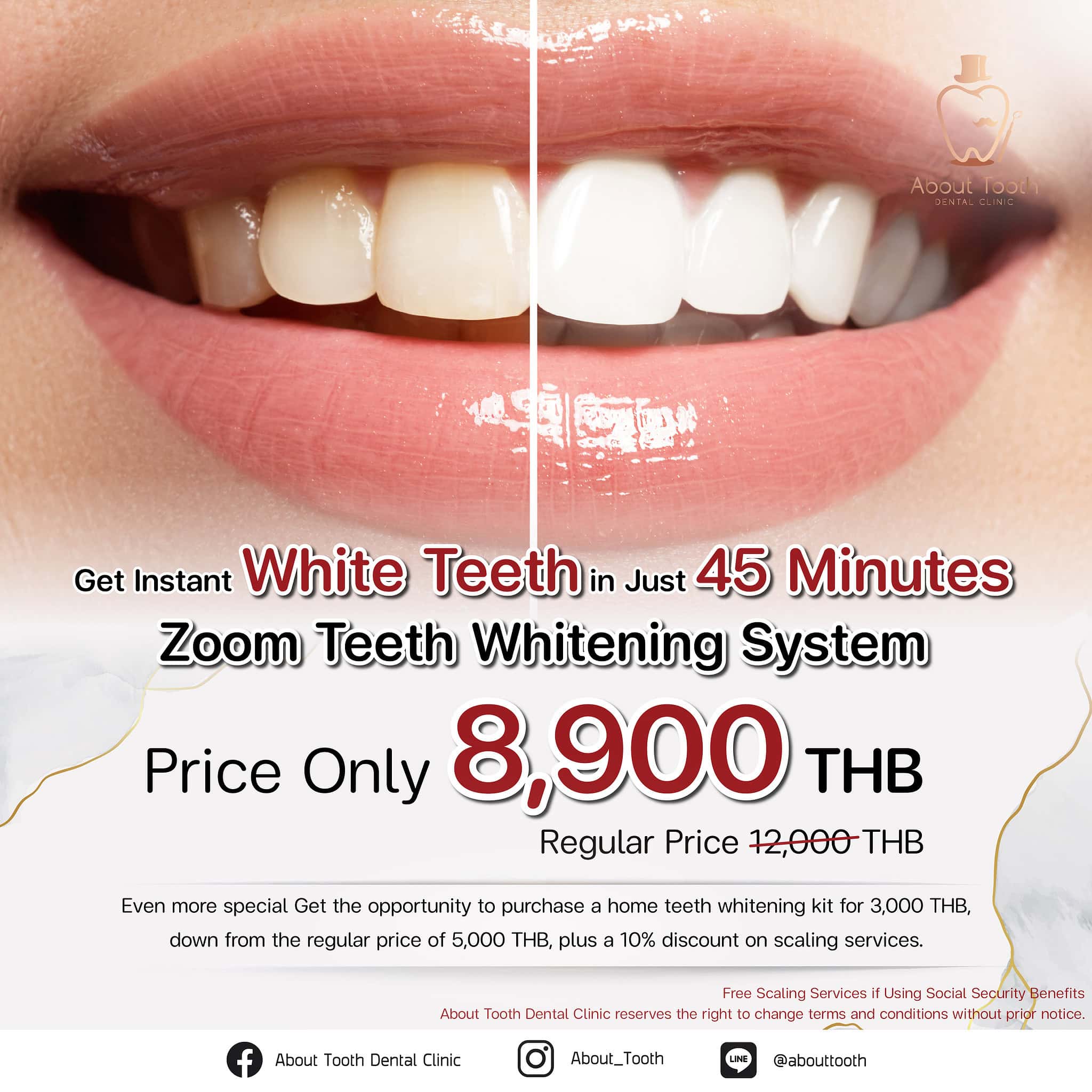 Zoom! Teeth Whitening - About Tooth Dental Clinic